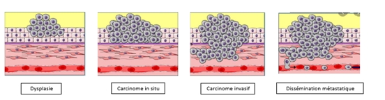 [1ère Spé SVT] Thème 4 - Variation génétique et santé - Sujet : Un ...
